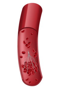 Filtro-vena-cava | Sociedad Española de Radiología Vascular e ...