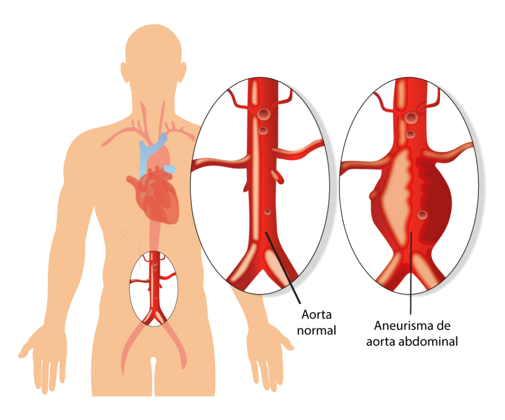 Aneurisma de Aorta Abdominal (AAA) | SERVEI