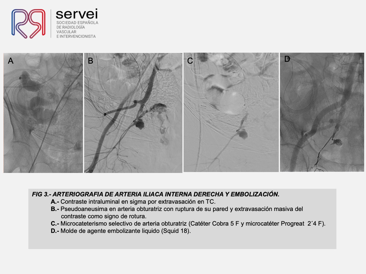 Pseudoaneurisma roto de arteria obturatriz | Caso clínico RVI