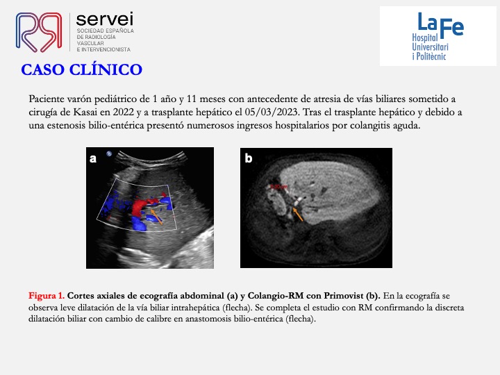 Estenosis bilio-entérica pediátrica | Caso clínico SERVEI